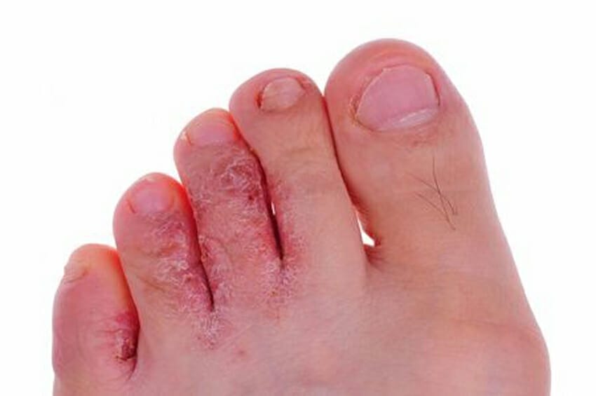 Foot Cellulitis - Things You Should Know | Ecellulitis Healthy Living