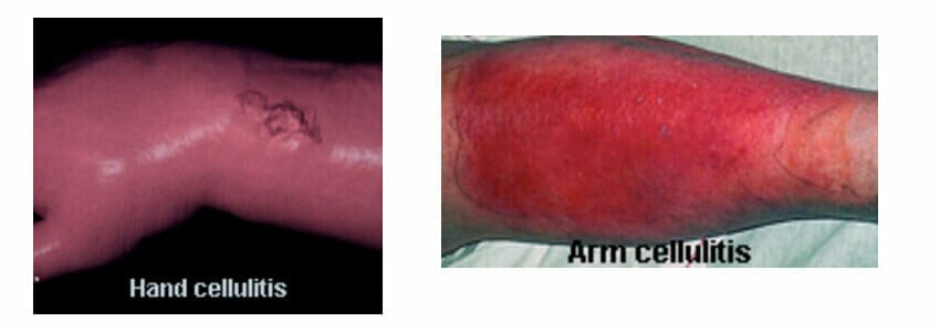 Hand Cellulitis: Causes, Symptoms, Risk Factors, Treatment Options