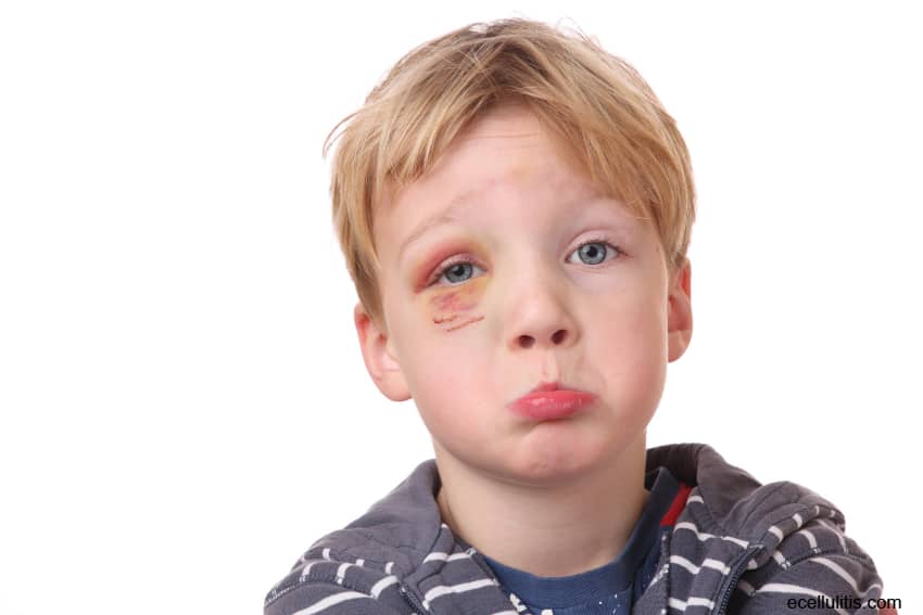 Cellulitis in Children | Ecellulitis Healthy Living Magazine